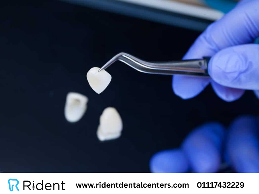 الفرق بين الفينير واللومينير | Rident Dental Centers