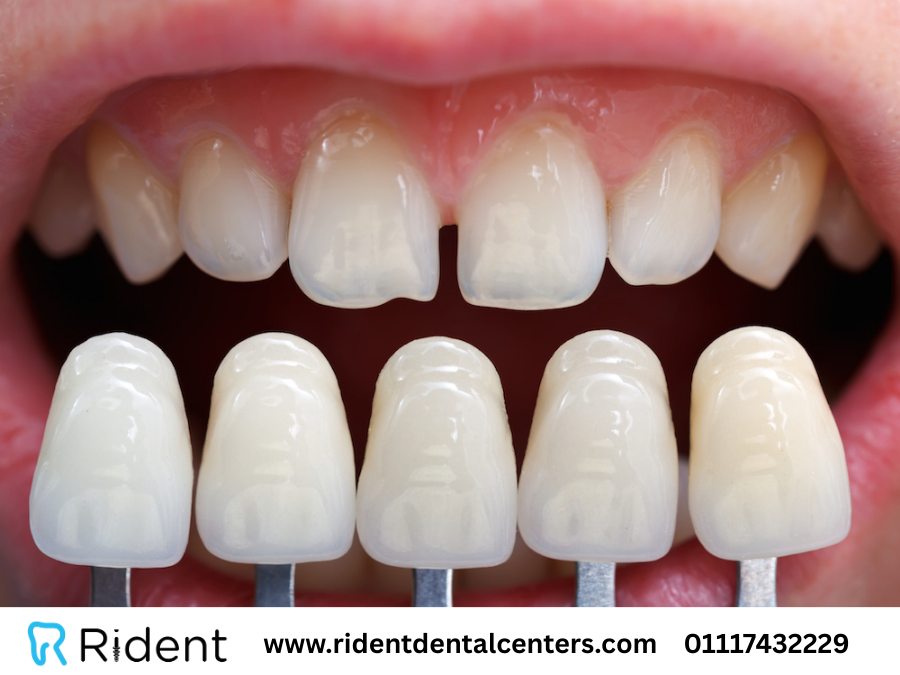 تجميل الاسنان بـ 11 طريقة مختلفة في ملف شامل | Rident Dental Centers