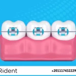 كيف يتم شد تقويم الاسنان | Rident Dental Centers