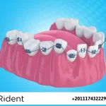 مراحل تقويم الاسنان | Rident Dental Centers